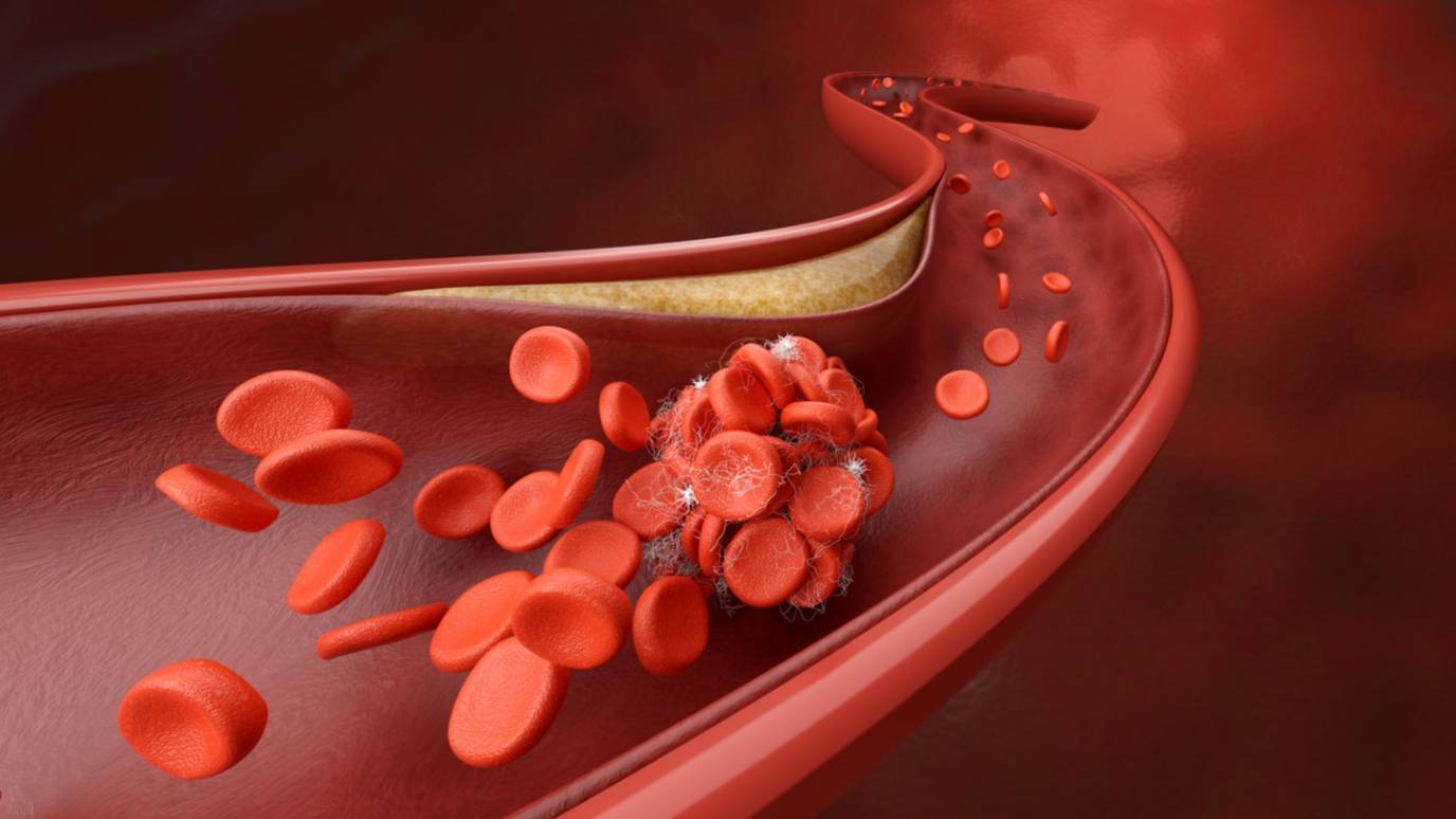 Novel Treatment for Polycythemia Vera Shows Promise in Clinical Trial ...