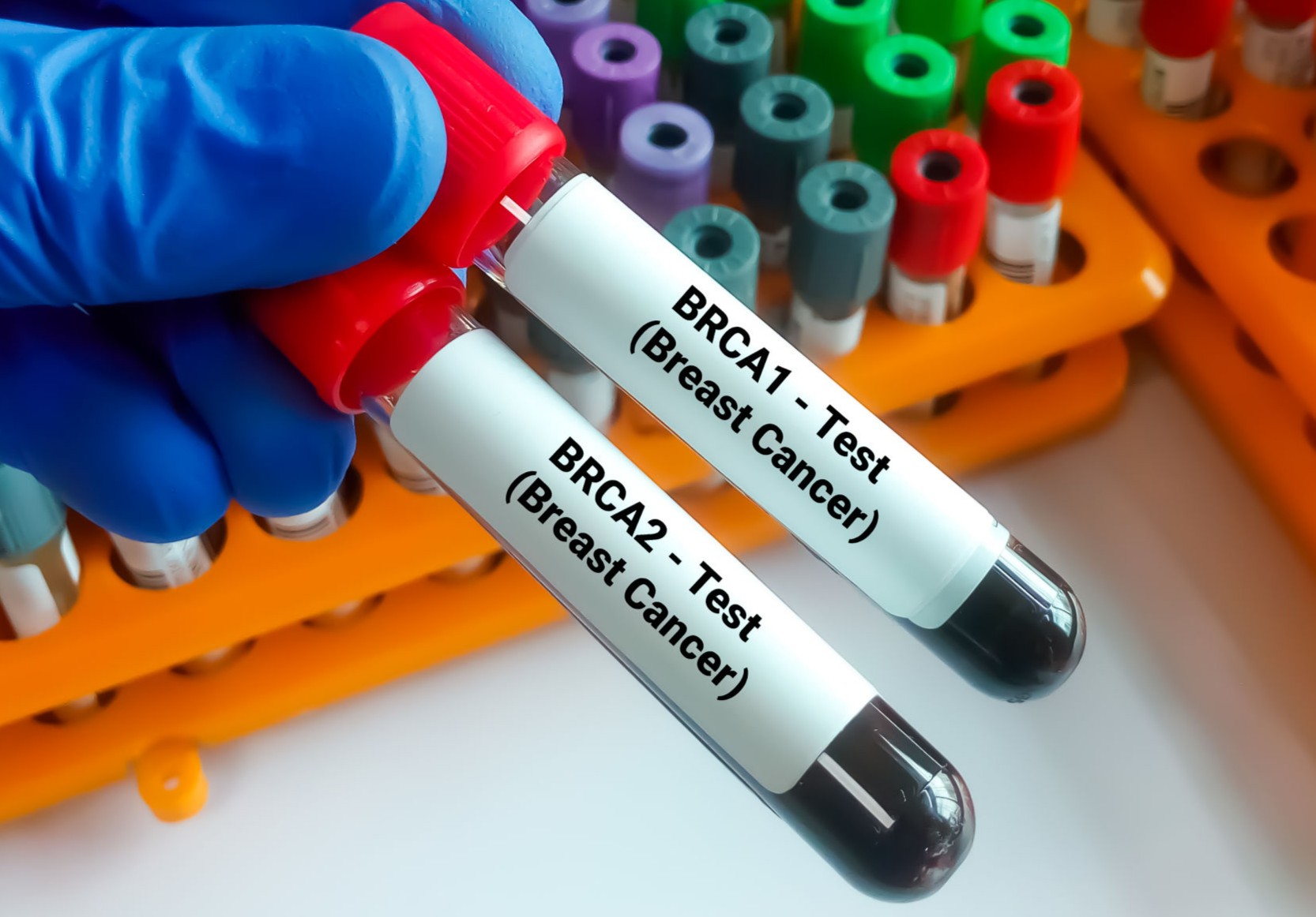 New Guidelines Expand BRCA Testing and Screening for Men - - AXISMedEd